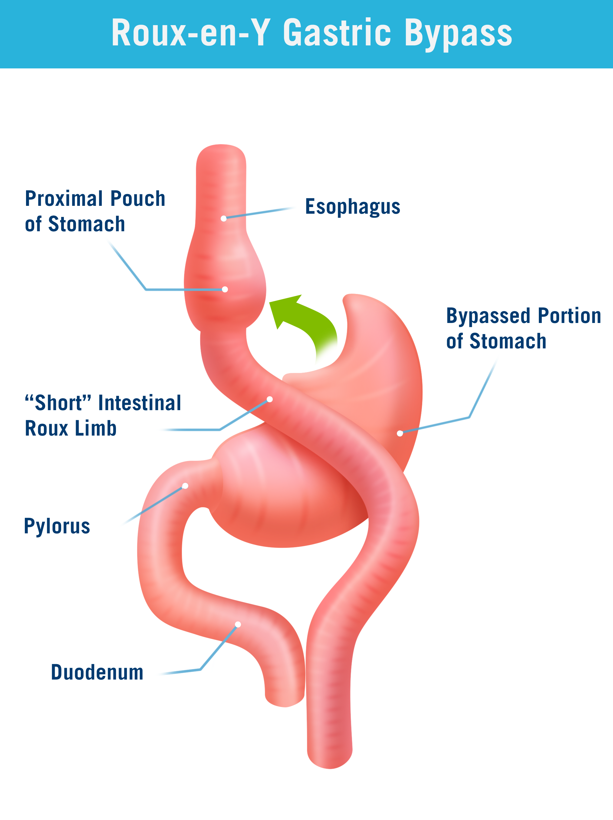 Roux En Y Gastric Bypass Roux Limb